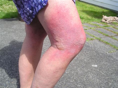 Giant Hogweed Vs Cow Parsnip What Is The Difference Ckiss Central Kootenay Invasive