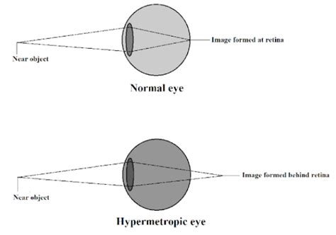 Make A Diagram To Show How Hypermetropia Is Corrected The Near Point Of The Hypermetropic Eye