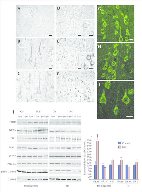 Nmda Receptor Expression And Composition Are Altered In Type Ia Fcd