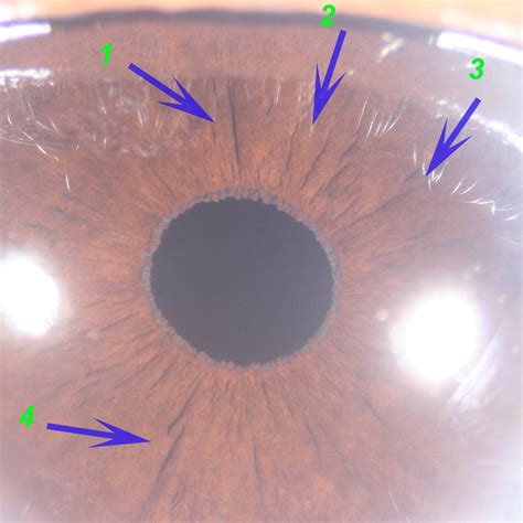 Modern And Multidimensional Iridology Radial Furrows