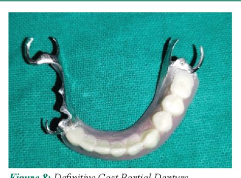 Figure 8 From Marginal Mandibulectomy Defect Rehabilitated With Cast
