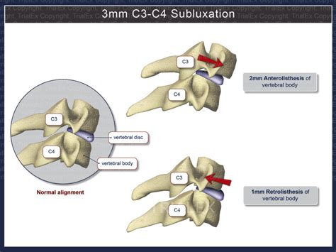 3mm C3 C4 Subluxation Trialquest Inc