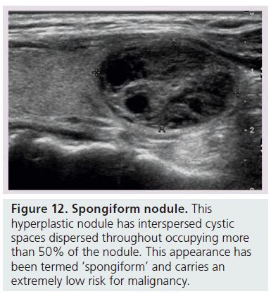 Thyroid Nodule Ultrasound Findings