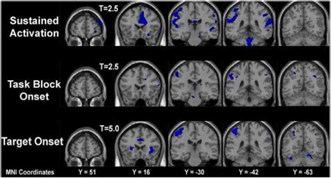 Attention Deficits In Schizophrenia Preliminary Evidence Of Dissociable Transient And Sustained