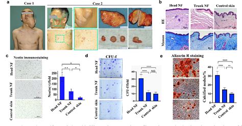 Figure 2 From Distinctive Mesenchymal Like Neurofibroma Stem Cells Shape Nf1 Clinical Phenotypes