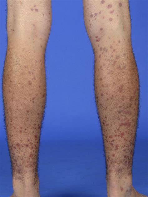 Iga Vasculitis Henoch Schönlein Purpura Treatment And Management