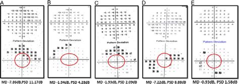 Different Arcuate Like Pattern Defects Of 10 2 Visual Fields A Download Scientific Diagram