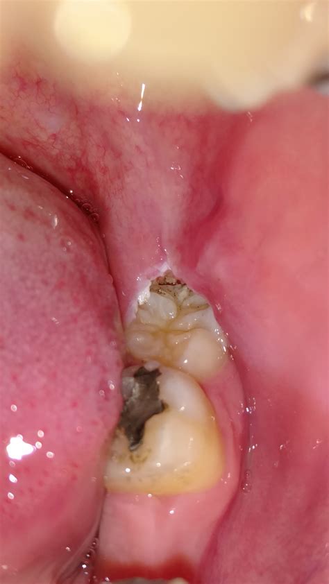 Just Had Operculectomy For Impacted Wisdom Tooth And Discovered Something New Under It