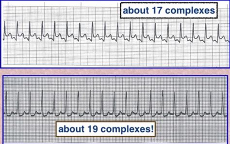 Cardiac Dysrhythmias Supraventricular Tachycardias Svt Flashcards Quizlet