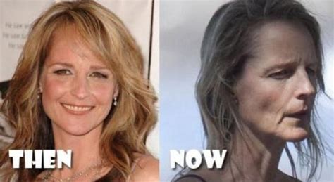 Helen Hunt Before And After The Apocalypse Bad Plastic Surgeries