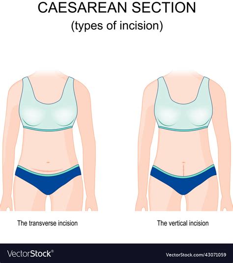 Cesarean Section Incision Types