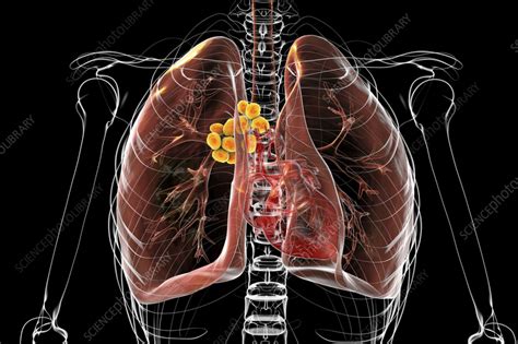 Mediastinal Lymphadenopathy 3d Illustration Stock Image F0424975