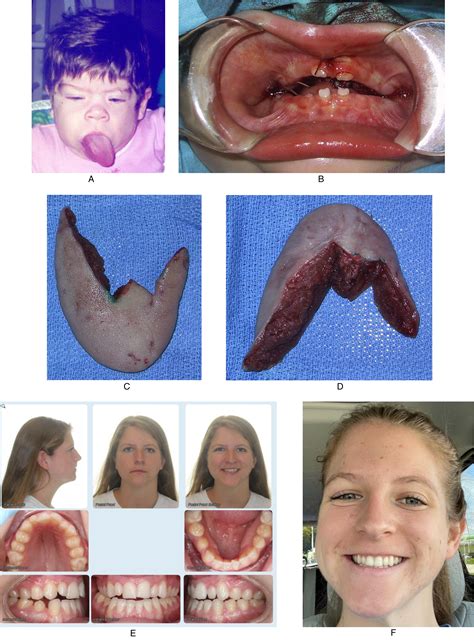 Beckwith Wiedemann Syndrome Tongue Treatment
