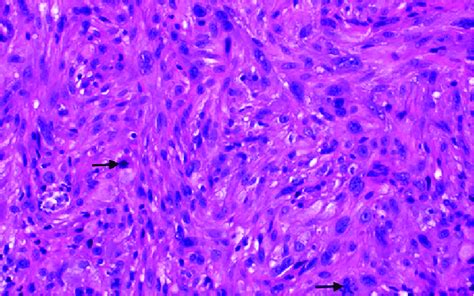 High Power View Of The Tumor Showing Marked Nuclear Pleomorphism With