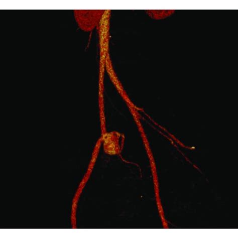 Duplex Ultrasound Of The Abdomen At 12 Month Follow Up Showed Triphasic