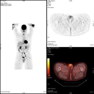 51 Year Old Male With Diffuse Large B Cell Non Hodgkin S Lymphoma Download Scientific Diagram