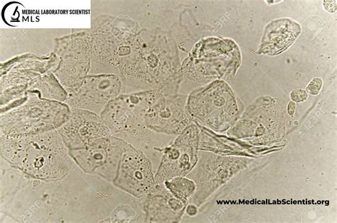 What Does Epithelial Cells In Urine Indicate My Projects