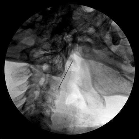 Glossopharyngeal Nerve Block Fluoroscopy