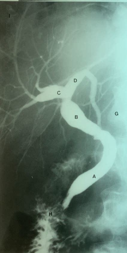 Diagram Of 108 Cholangiogram Cholecystectomy Quizlet