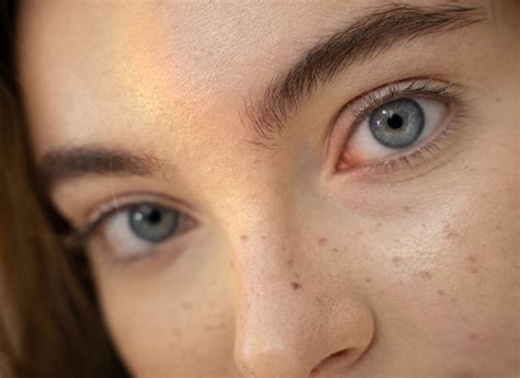 Thyroid Eye Disease Dr Sarah Avila