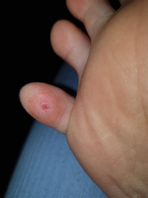 Is This The Wart Or Is It Natural Tissue Rwarts