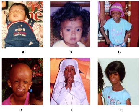 Progeria Symptoms Newborn