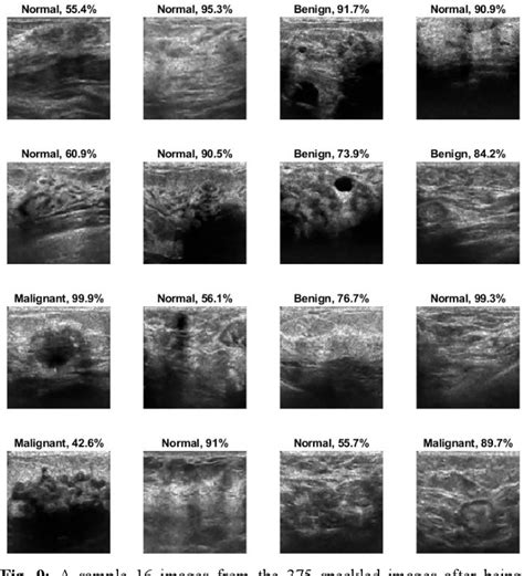 Figure 9 From Classification Of Breast Ultrasound Images Based On Convolutional Neural Networks
