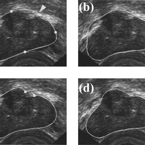 Operation Of The Prostate Segmentation Algorithm A Initial Outline