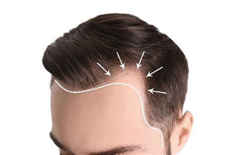How To Stop Your Receding Hairline