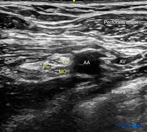 Regional Anesthesia Ultrasound View Of The Brachial Plexus At The