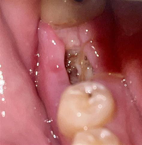Granulation Tissue Or Dry Socket R Askdentists