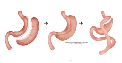 Procedimientos Bariátricos