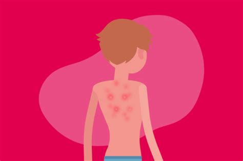 Termasuk Ringan Inilah Penyebab Munculnya Eritema Multiformis