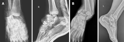 Tibiotalar Joint Dislocation