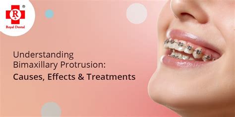 Maxillary Protrusion