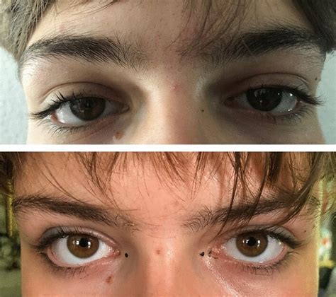 An 18 Year Old Female Adolescent With A Serologically Proven Primary