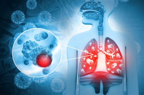 Campaña contra cáncer de pulmón llevará tomografías gratuitas a ...
