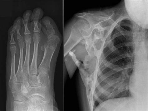 Can X Rays Detect Bone Cancer Vinmec