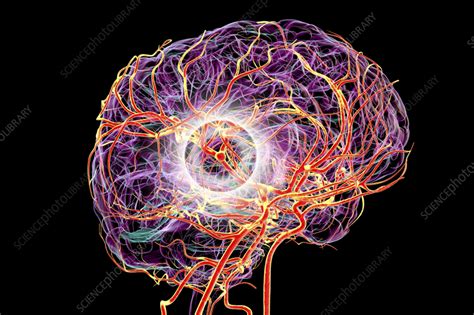Saccular Brain Aneurysm Illustration Stock Image F0439827