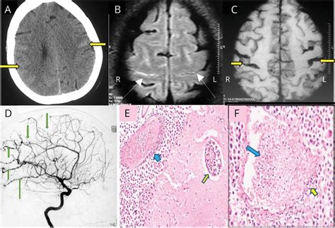 Figure Paraneoplastic Cerebral Vasculitis Leading To Convexity