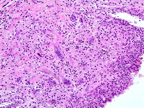 Pathology Outlines Stump