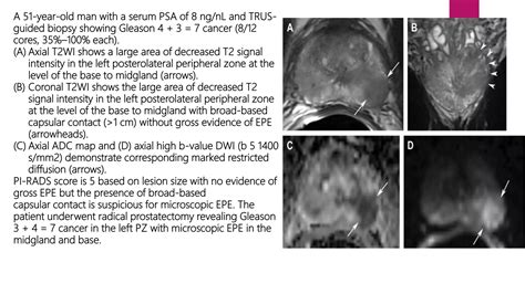 Multiparametric Mp Mri Of Prostate Cancer Pptx