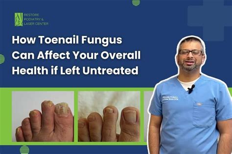 How Toenail Fungus Can Affect Your Health If Left Untreated