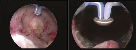 Pre And Postoperative Aspect Of The Prostatic Fossa Download Scientific Diagram