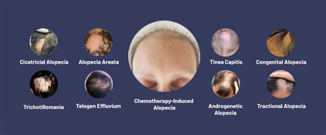 Male Pattern Baldness Genetic Inheritance Sex Influenced Traits Male