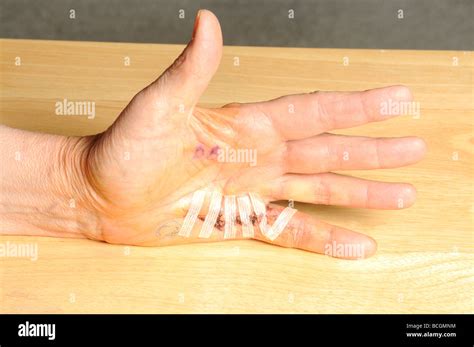 Dupuytren Hand Surgery Fasciectomy For Dupuytrens Disease Surgery