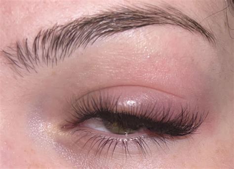 Update My Eye Is Getting More Swollen Should I Remove These Before Going To The Gp R