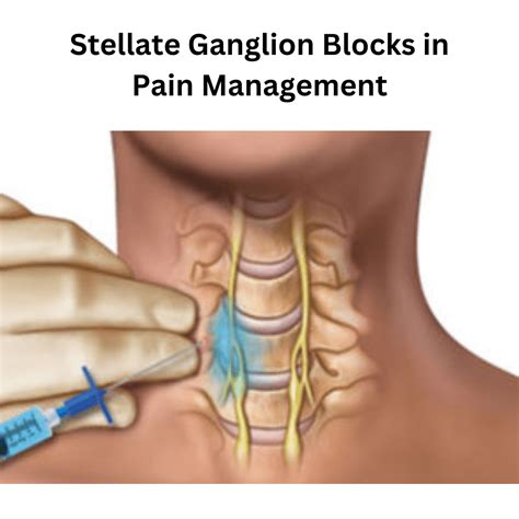 Stellate Ganglion