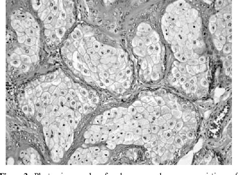 Oral Cavity Adenoma Semantic Scholar