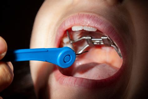 what is a palatal expander and how does it work precision
